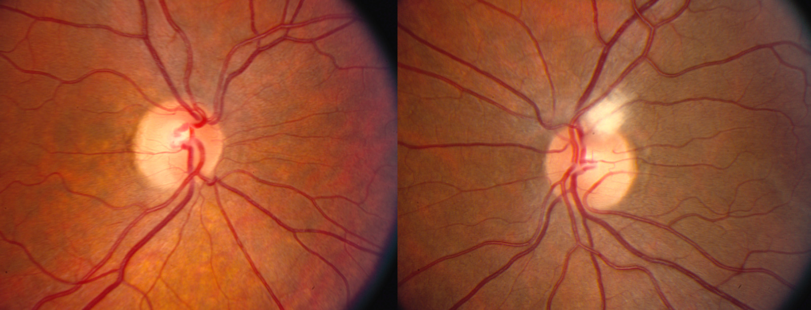 abnormal optic nerve head