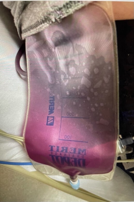 Porphyria Purple Urine