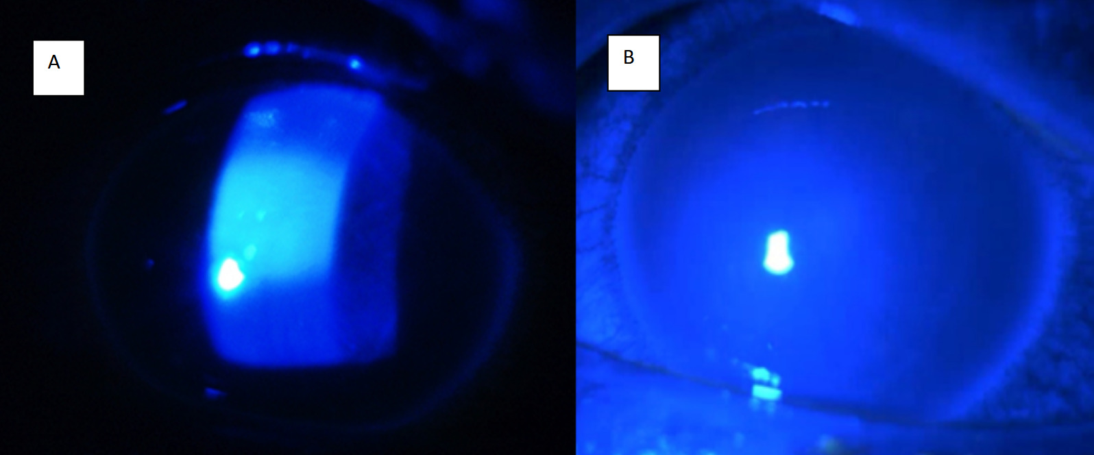 A Case Series of Geographic Corneal Epithelial Defects Secondary to ...