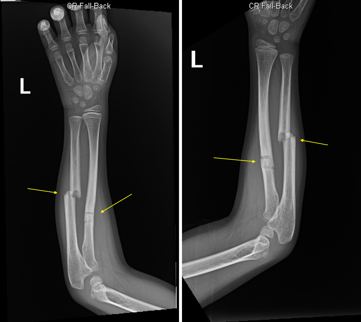 ulna bone crack