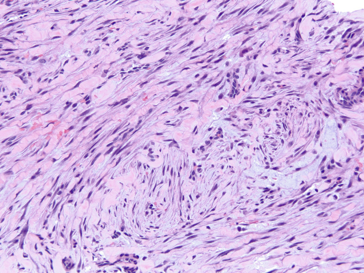 Intra-Articular Nodular Fasciitis of the Knee, A Rare Clinical Presentation and Histological ...
