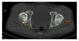 Morphological Characteristics of the Vietnamese Adult Human Acetabulum ...