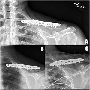 Managing Recurrent Clavicle Nonunion and Construct Failure: A Case ...