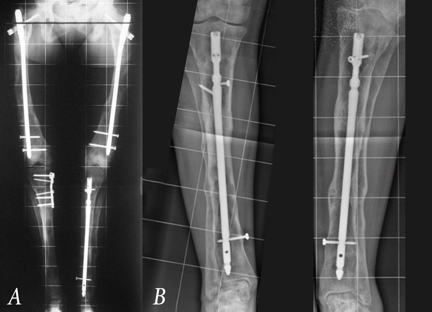 Surgical correction of valgus deformities of the knee in Polyostotic ...