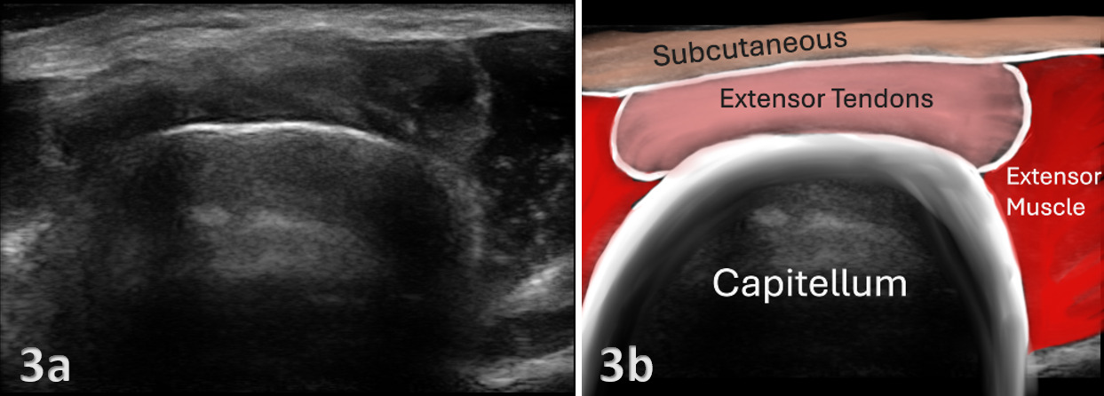 Diagnostic Musculoskeletal Ultrasound for the Evaluation of the Lateral ...
