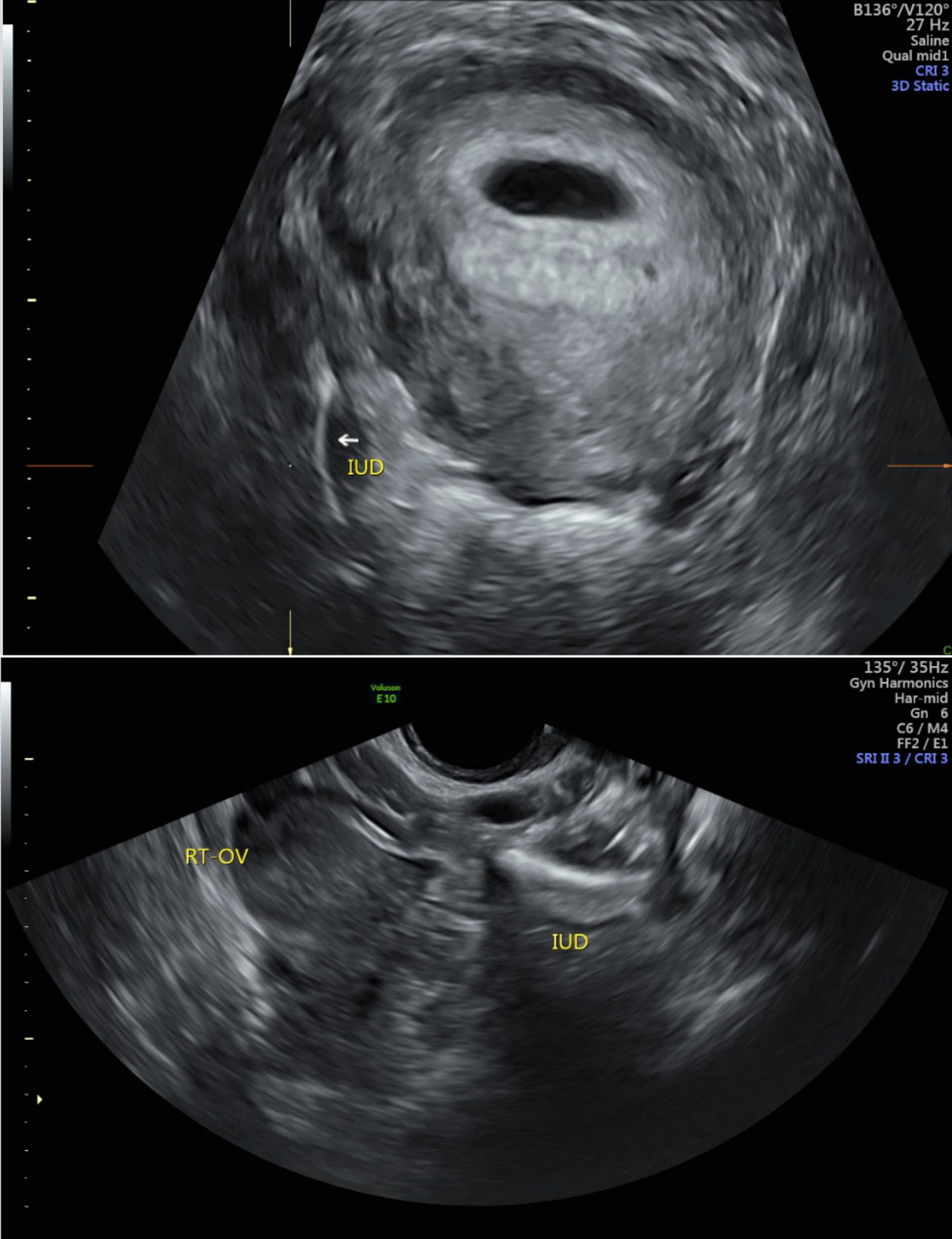 Retroperitoneal migration of an intrauterine device: a case report ...