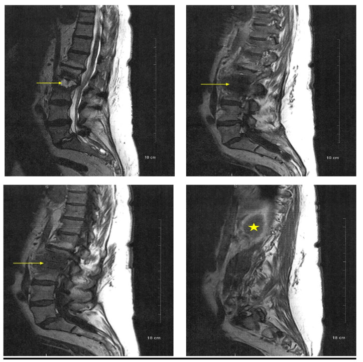 psoas abscess recurrence