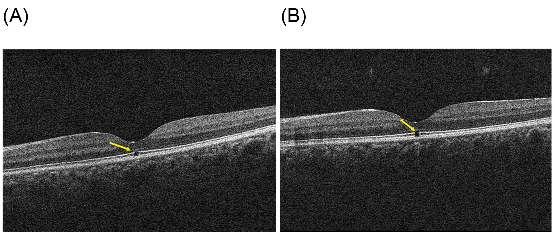 Case Report: Solar Retinopathy Secondary to the Viral Tik Tok Trend “# ...