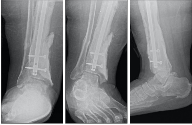 Maintenance of a cement spacer as definitive treatment of post ...