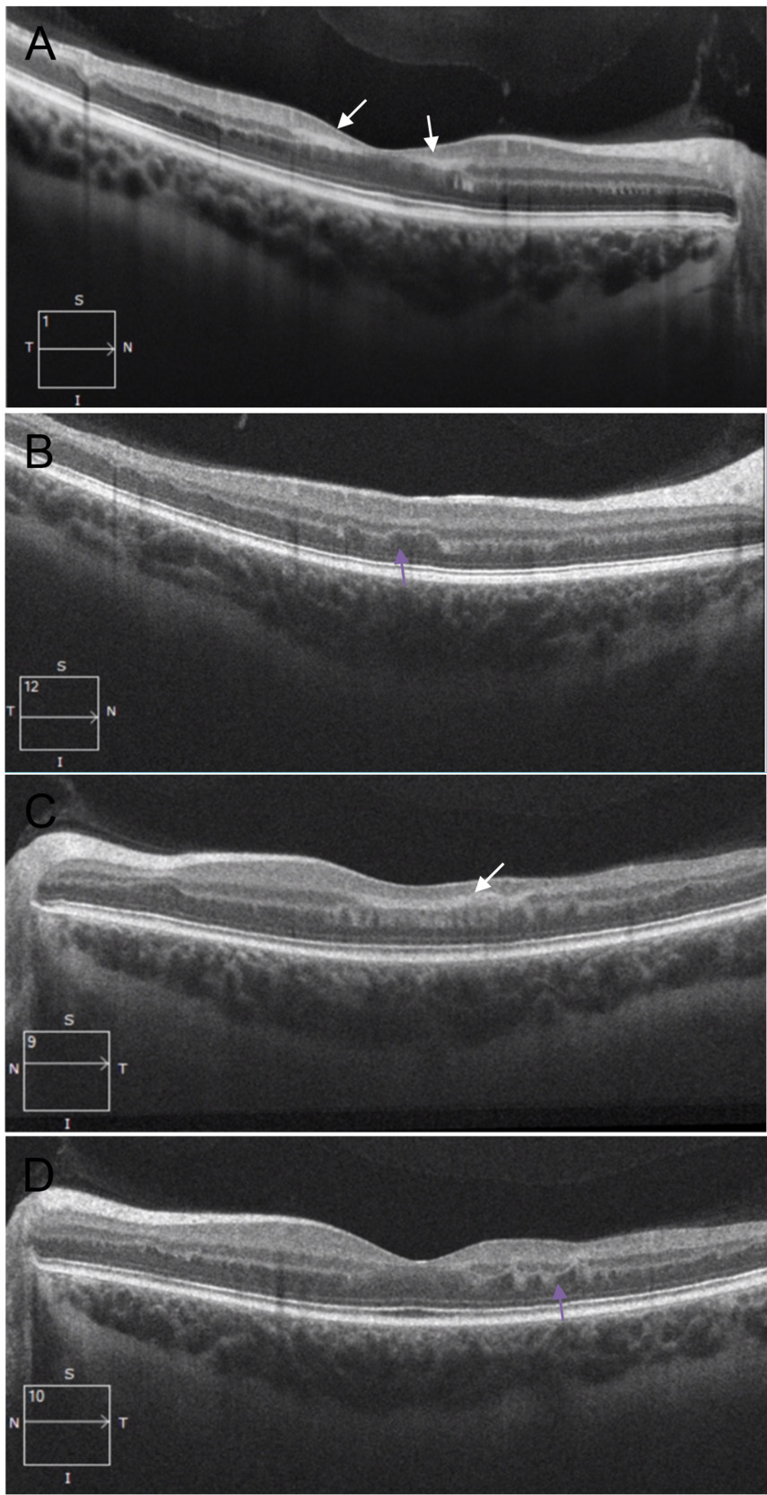 Case Report: Paracentral Acute Middle Maculopathy Associated with ...