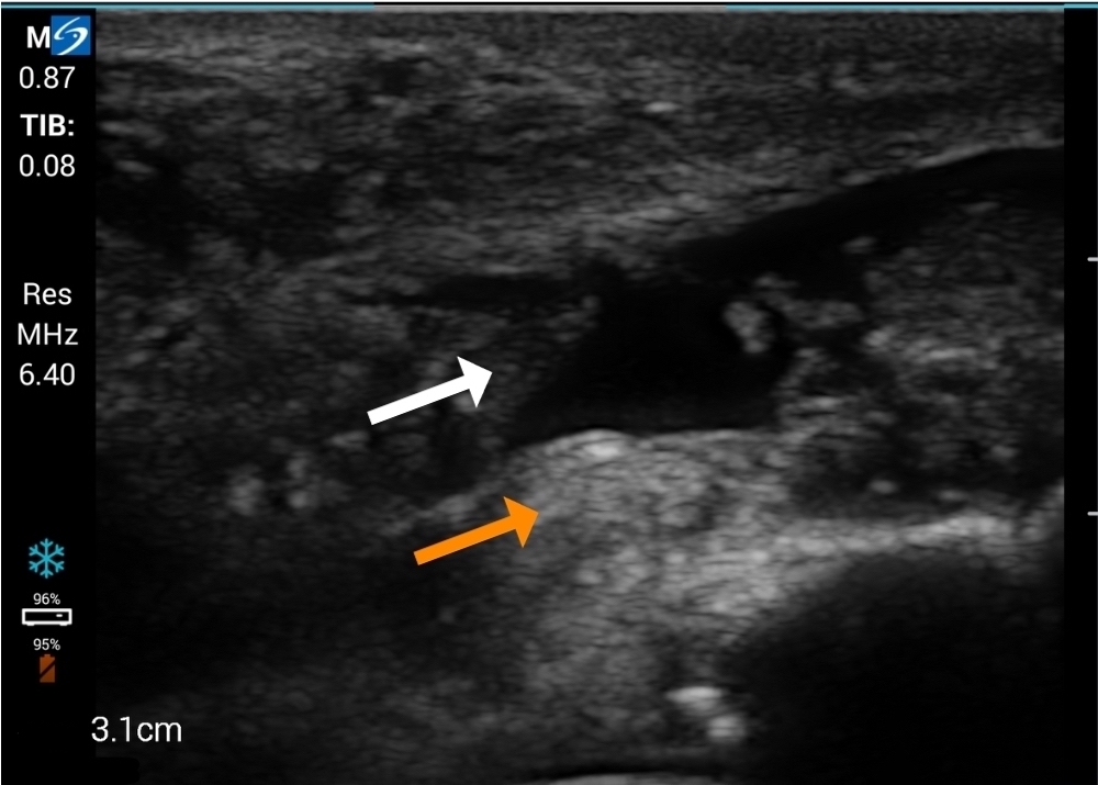 Triceps Tendon Avulsion in a Soldier: A Case Report | Published in ...
