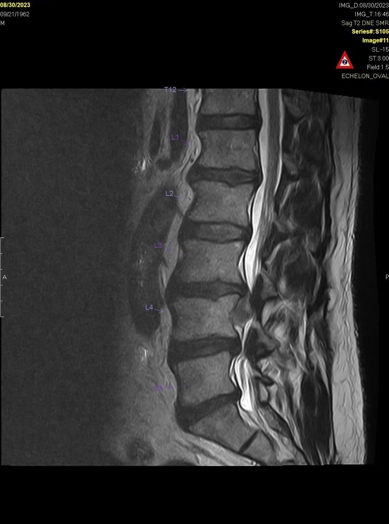 NON-SURGICAL CHIROPRACTIC MANAGEMENT OF A MASSIVE LUMBAR DISC EXTRUSION ...