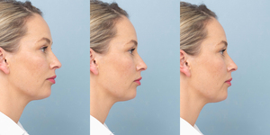 A standardised system of photography to assess cosmetic facial surgery ...