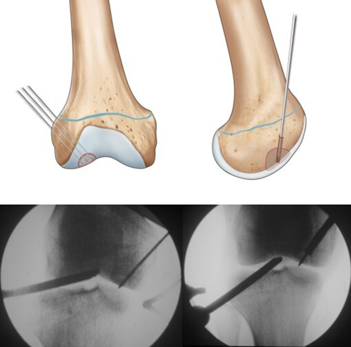An update on osteochondritis dissecans of the knee | Published in ...