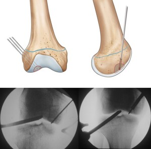 An update on osteochondritis dissecans of the knee | Published in ...