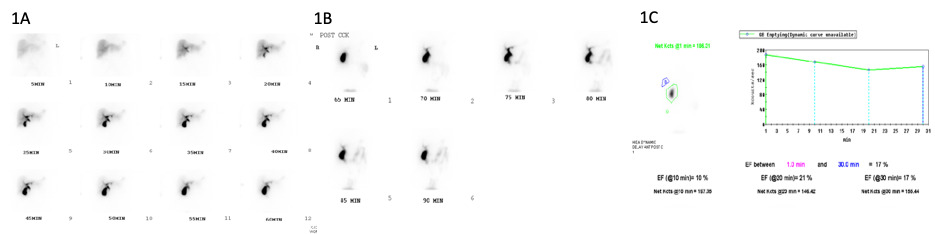 Biliary Dyskinesia with Reduced Gallbladder Ejection Fraction: A ...