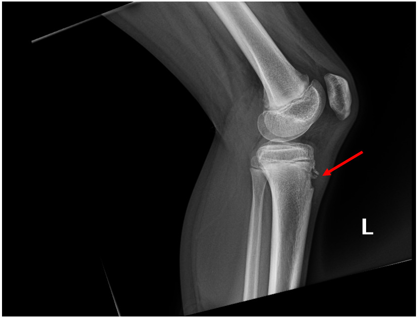 Diagnosis and Management of Osgood Schlatter Disease | Published in ...