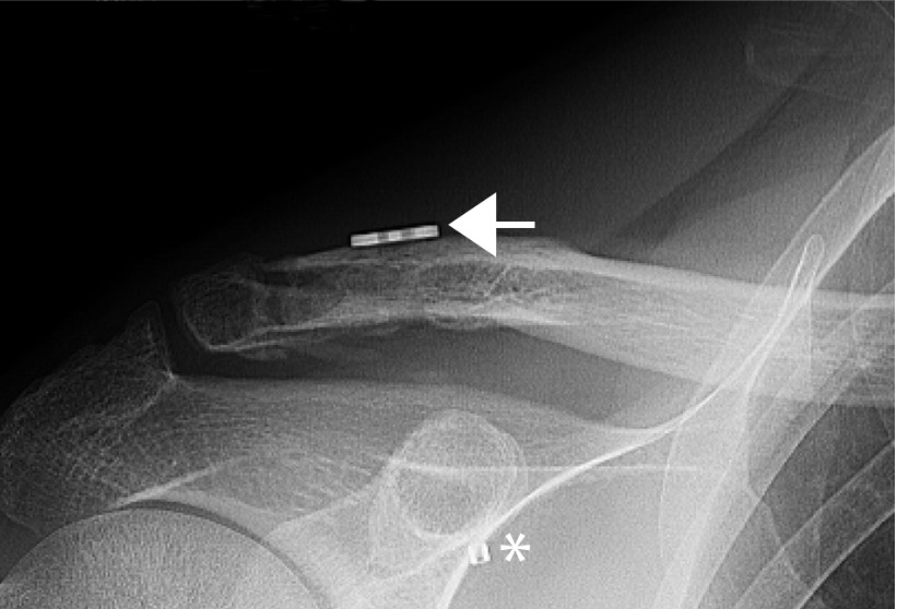 Percutaneous Coracoclavicular Tightrope Reduction of a Displaced Distal ...