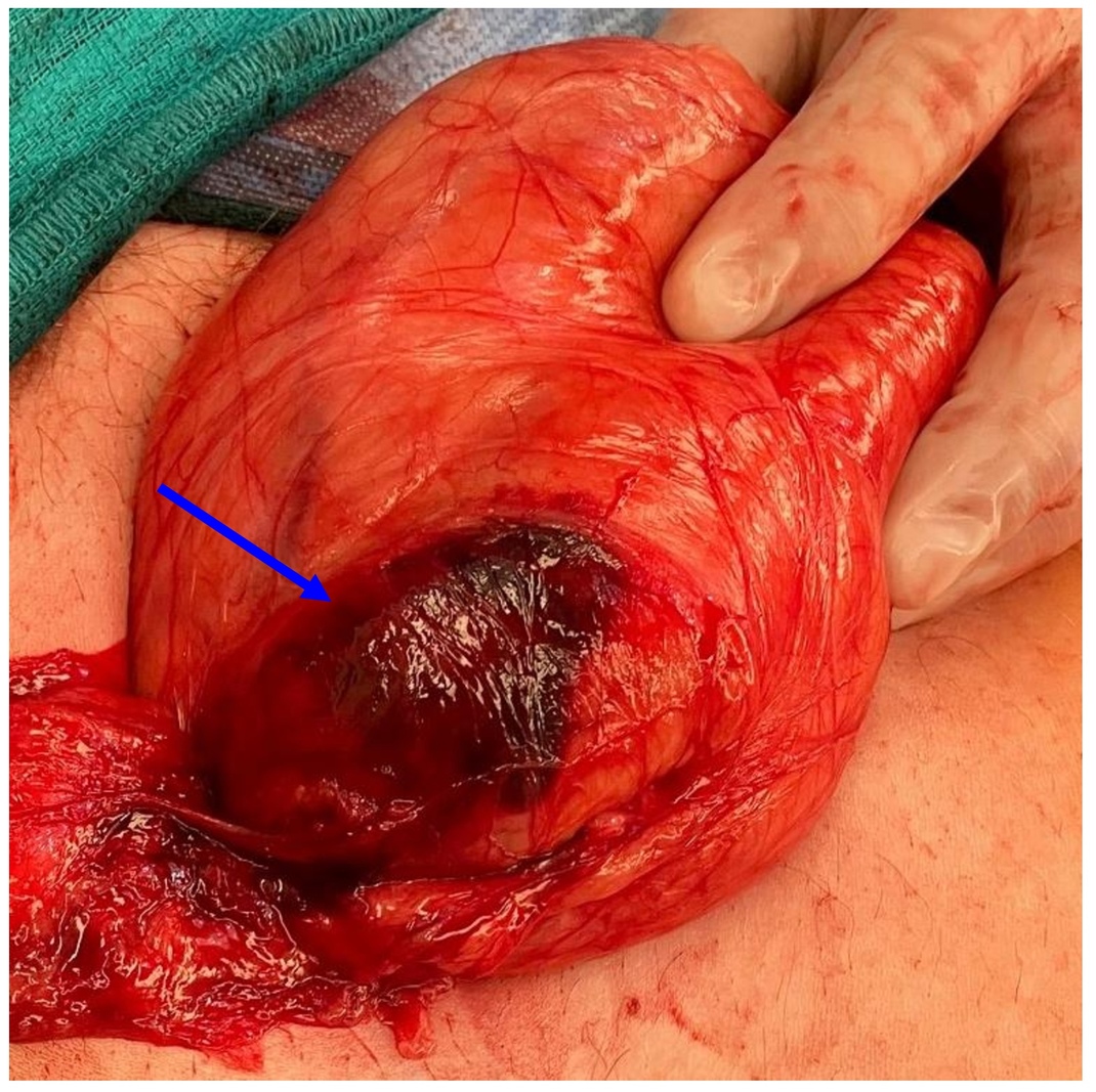 internal bleeding after bowel surgery