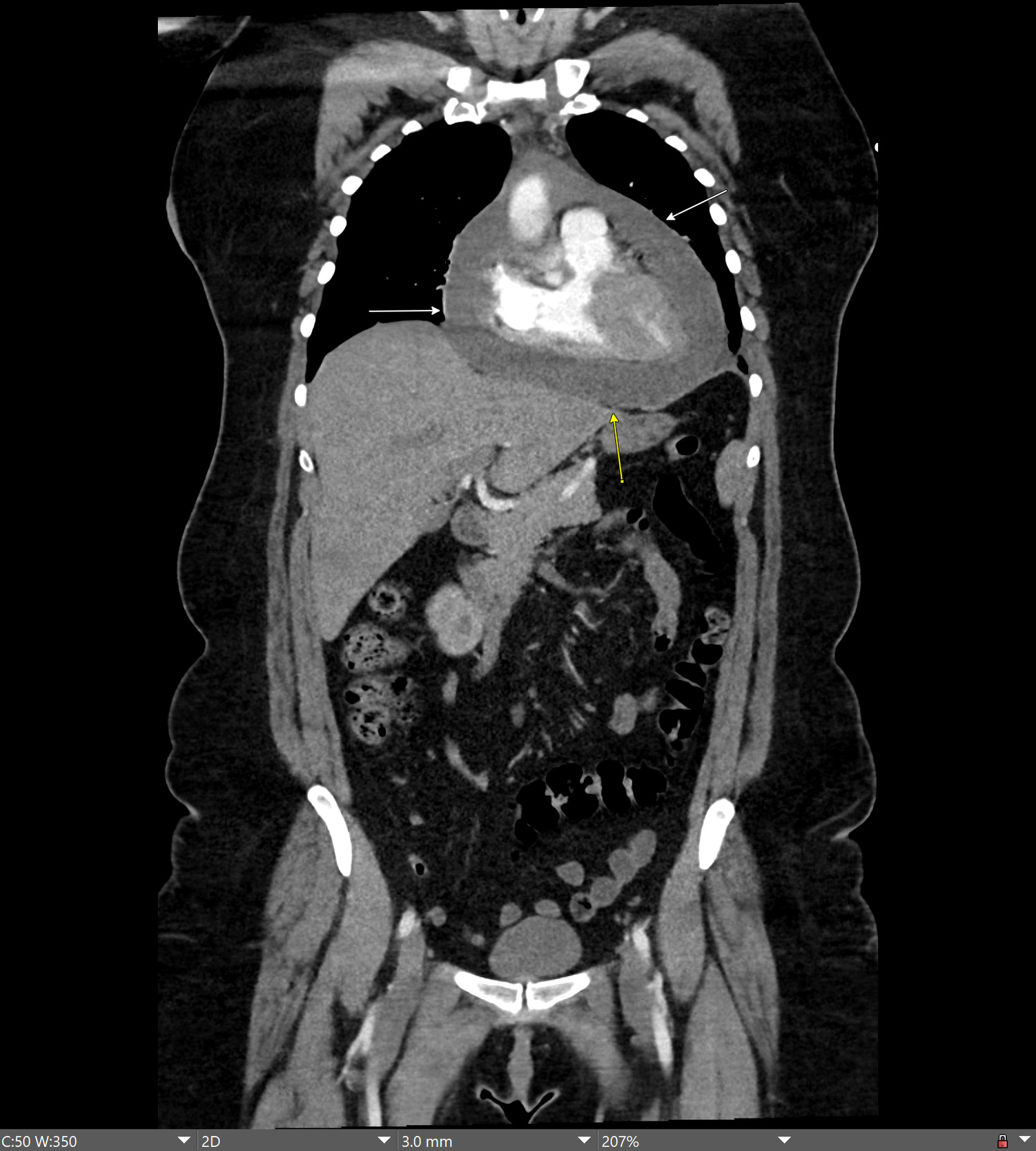 Large Hemorrhagic Pericardial Effusion and Cardiac Tamponade Following ...