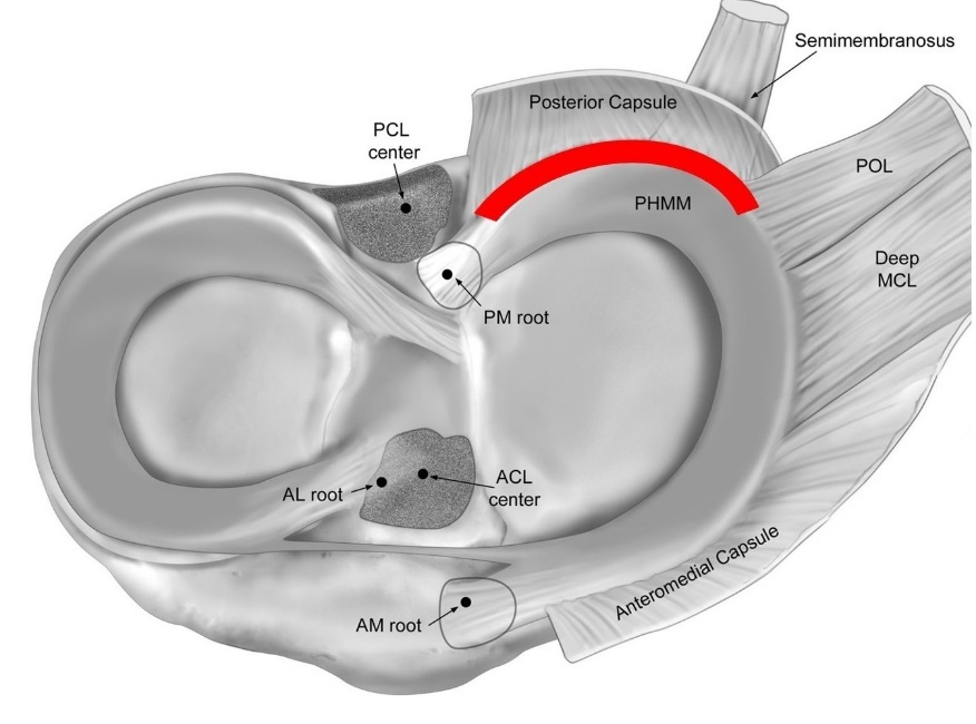 Posterior Medial Meniscus Root Tears: Clinical Implications, Surgical Management, and Post ...