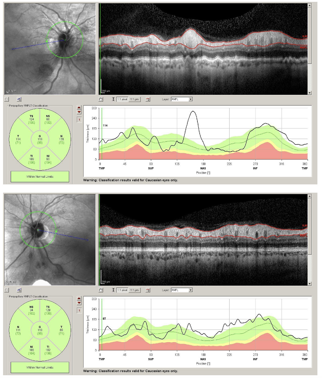 Case Report: A Case of Anemic Retinopathy in Severe Microcytic Anemia ...