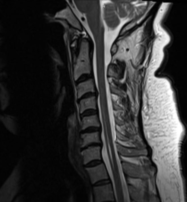 NON-SURGICAL SPINAL DECOMPRESSION IN POST-TRAUMATIC SYRINGOMYELIA: A ...