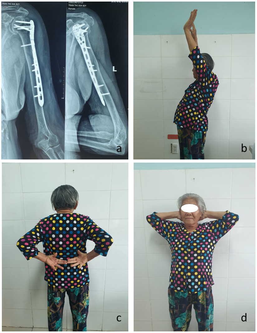 Minimal invasive plate osteosynthesis for the dislocated humeral head ...