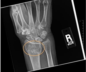 Distal Radius Fracture with Dorsal Angulation | Published in Orthopedic ...