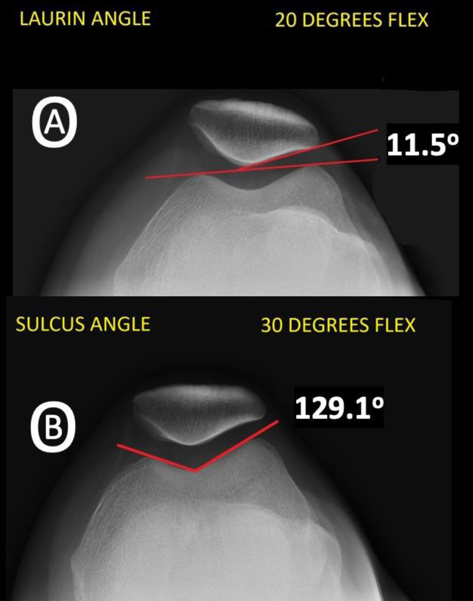 Understanding the patho-anatomy of patellofemoral pain: A crucial ...