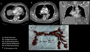 Saddle Pulmonary Embolus Treated With Bilateral Emergent Aspiration ...