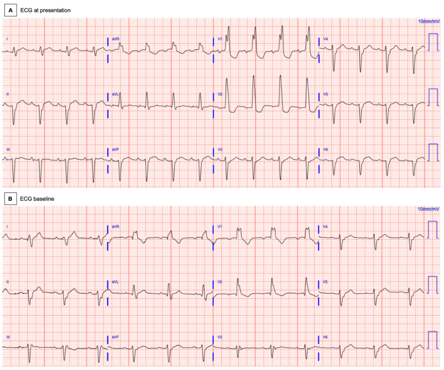 st segment changes in rbbb