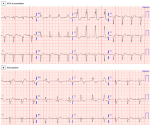 Posterior Occlusive Myocardial Infarction on Chronic Right Bundle ...