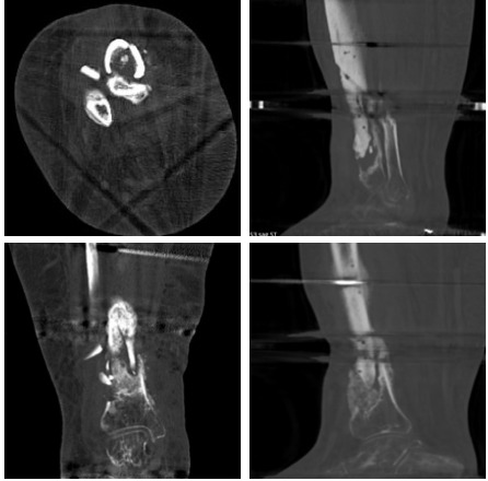 Maintenance of a cement spacer as definitive treatment of post ...