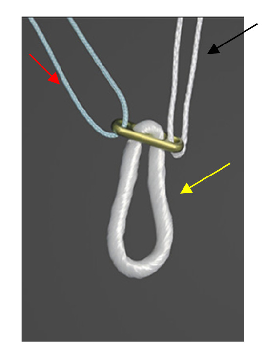 Medial patellofemoral ligament reconstruction using an endobutton ...