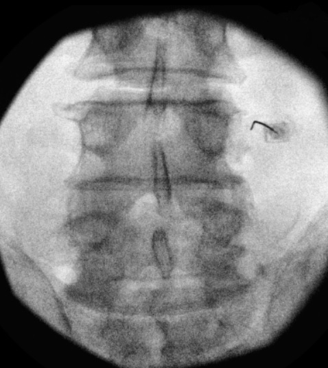 Erector Spinae Plane Block for Chronic Lumbosacral Pain: A Case Report ...