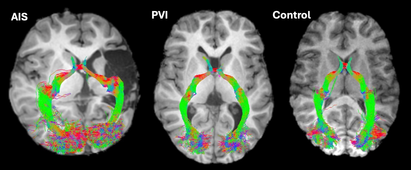 Bilateral differences in structural connectivity of the afferent visual ...