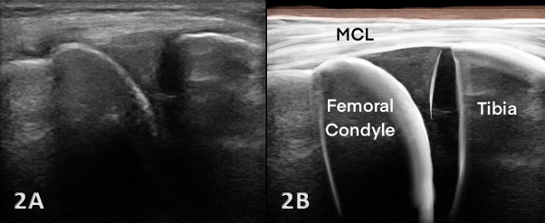 Diagnostic Musculoskeletal Ultrasound for Medial Collateral Ligament ...