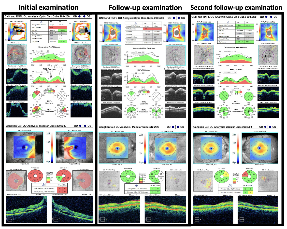 A Case Report of Papilledema Secondary to Hemangioblastoma | Published ...