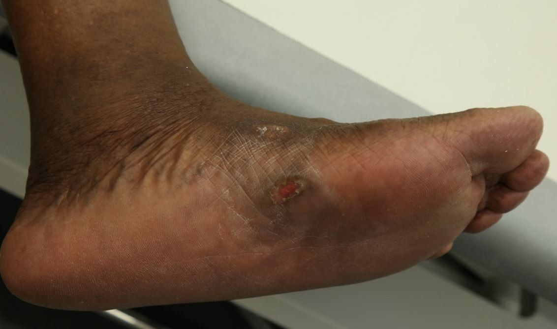 Recurrent Cutaneous Fusariosis in a Kidney Transplant Recipient – a ...