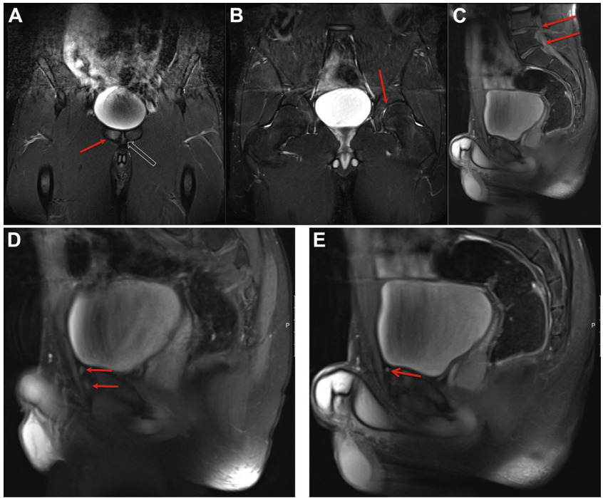Nonsurgical Management of Adductor-related groin pain with Ultrasound ...