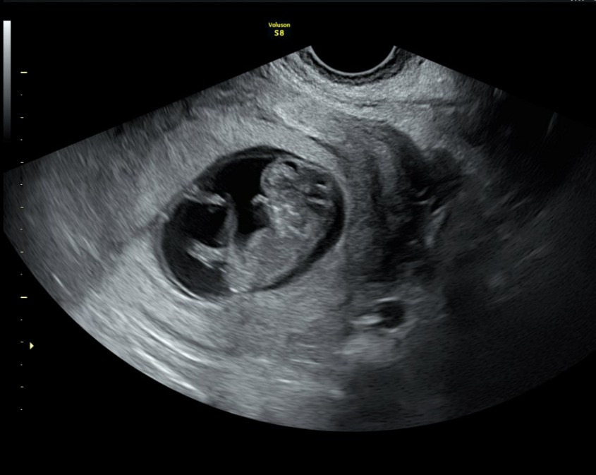 The Hidden Twin: A Case of Missed Heterotopic Pregnancy Revealed by ...
