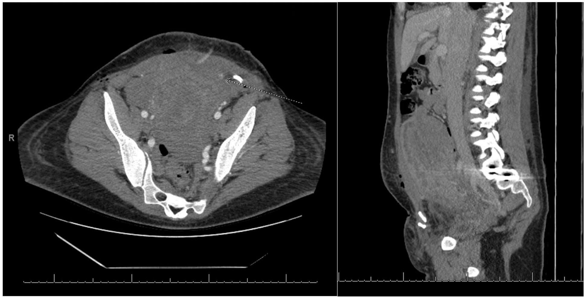 Rectus Abdominis Sheath Hematoma Following Cesarean Section: A Case ...