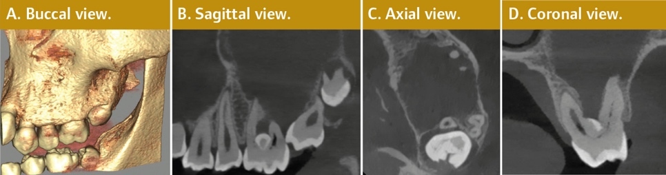 An inflammatory Odontogenic Cyst (Unusual Case): A case report ...