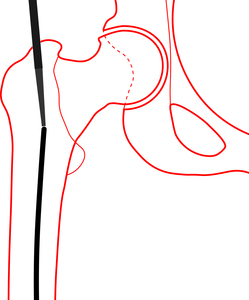 A Novel Technique for the Removal of an Intramedullary Femoral ...