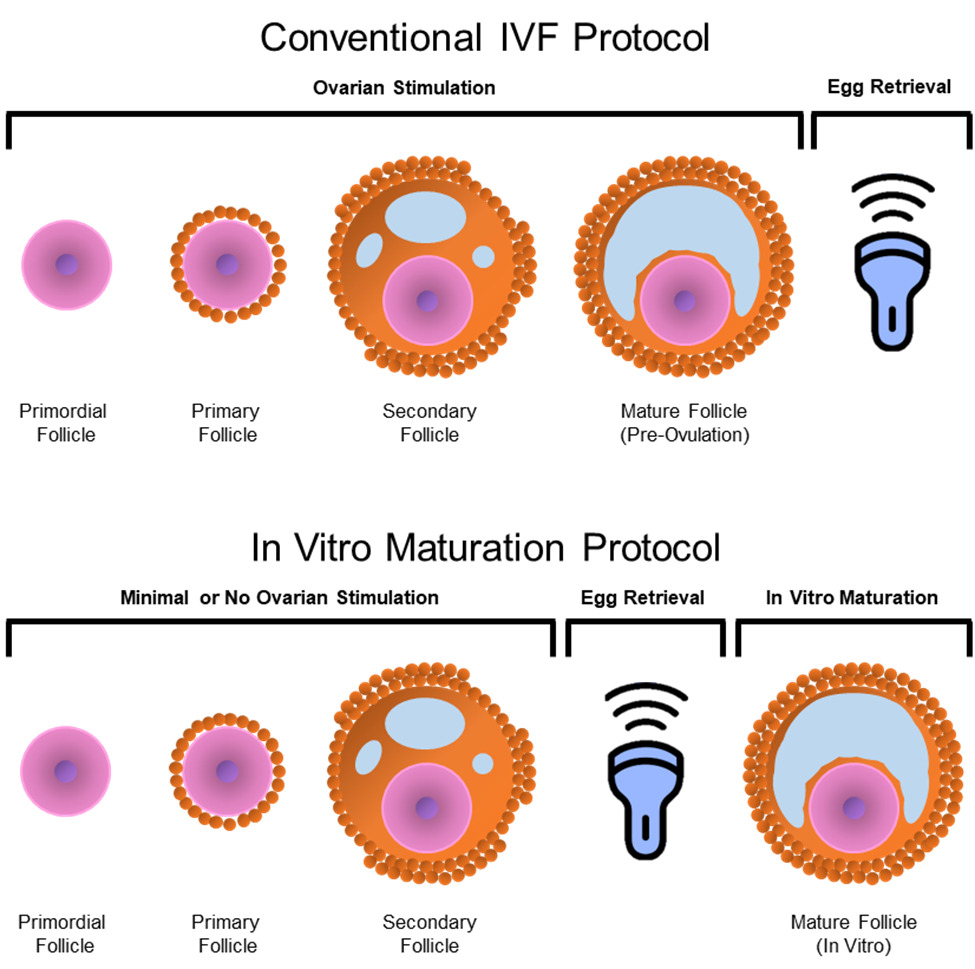 Review of minimally disruptive in vitro fertilization (IVF) approaches ...