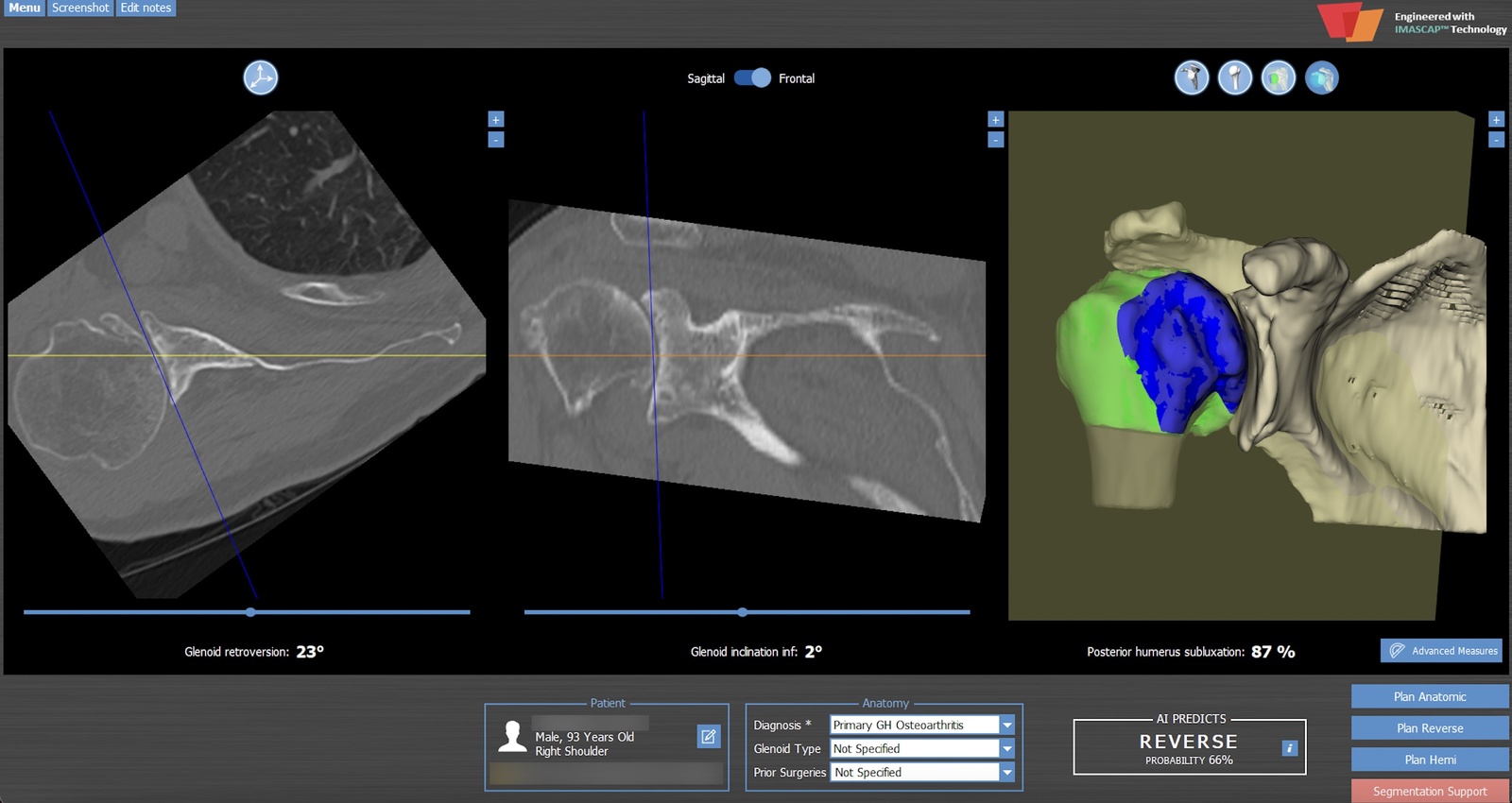 blueprint arthro complete