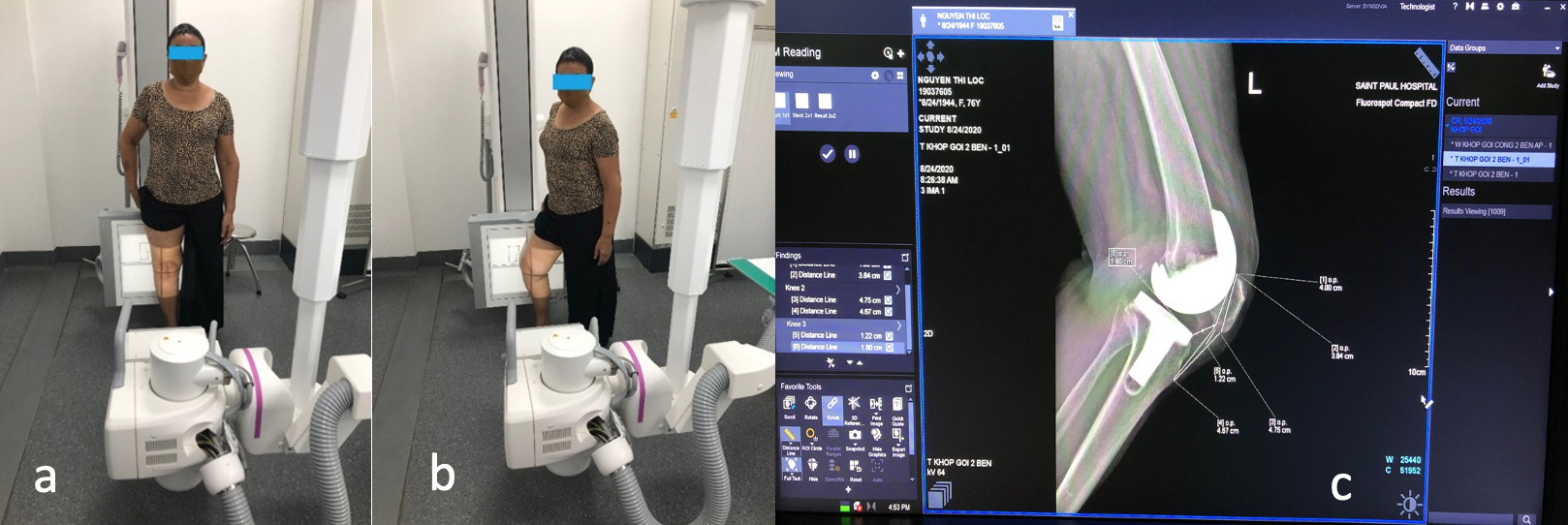 Influence of Changes in Patella Indices on Total Knee Replacement ...