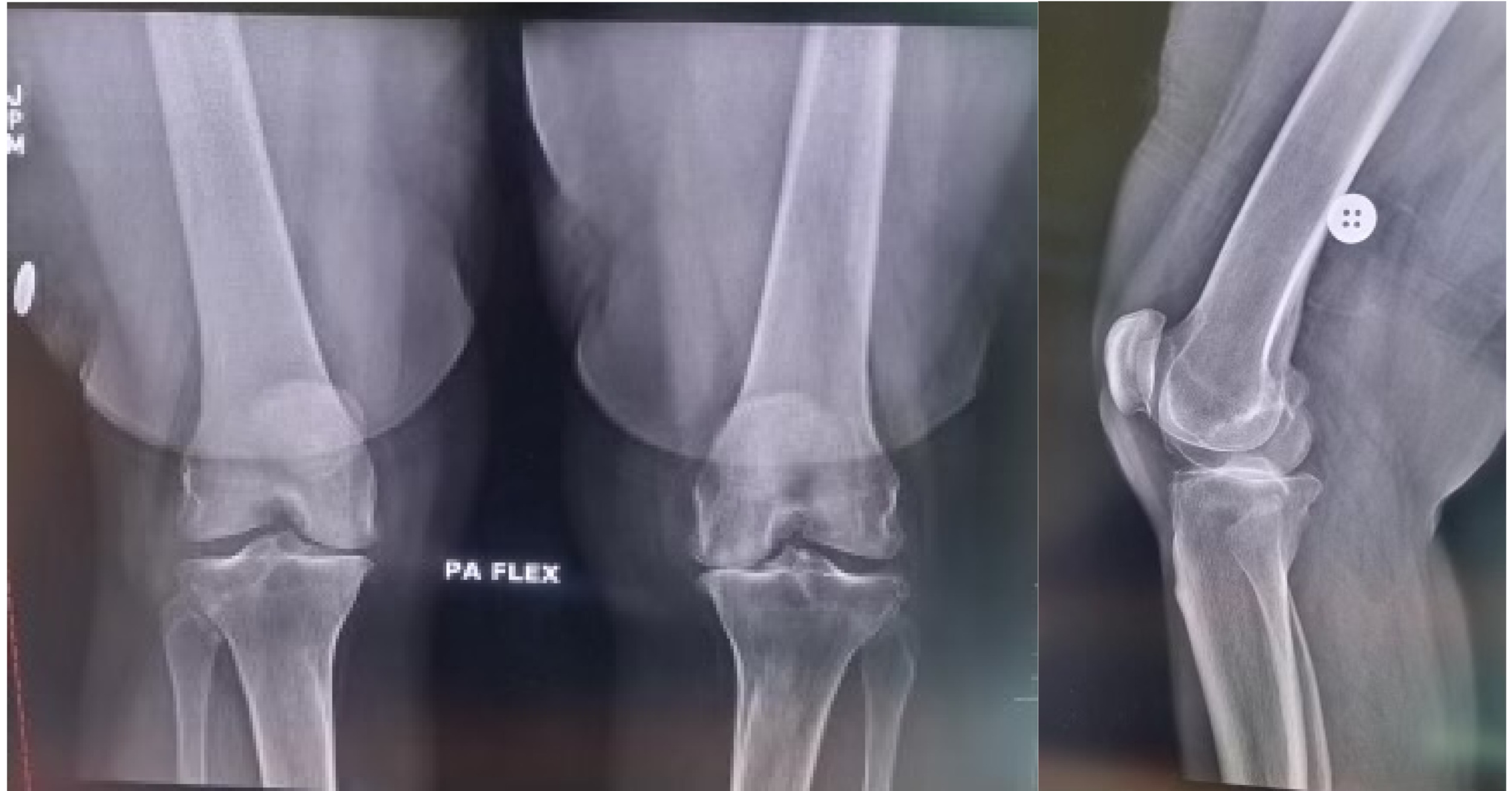 Objective gait analysis following total knee arthroplasty with a smart ...