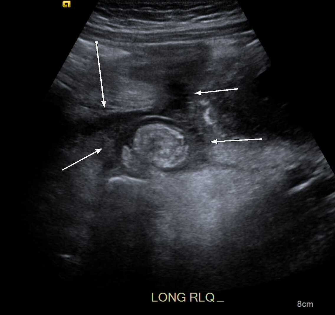meckel's diverticulum